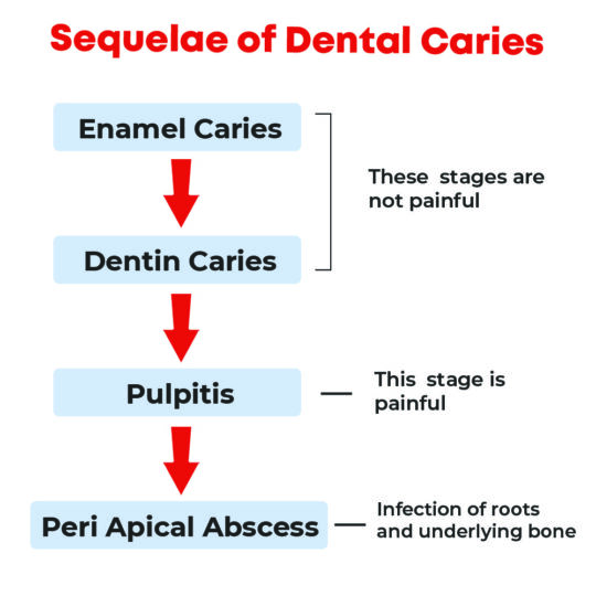 Sequelae of Dental Caries – Dr. Praveen's Dental